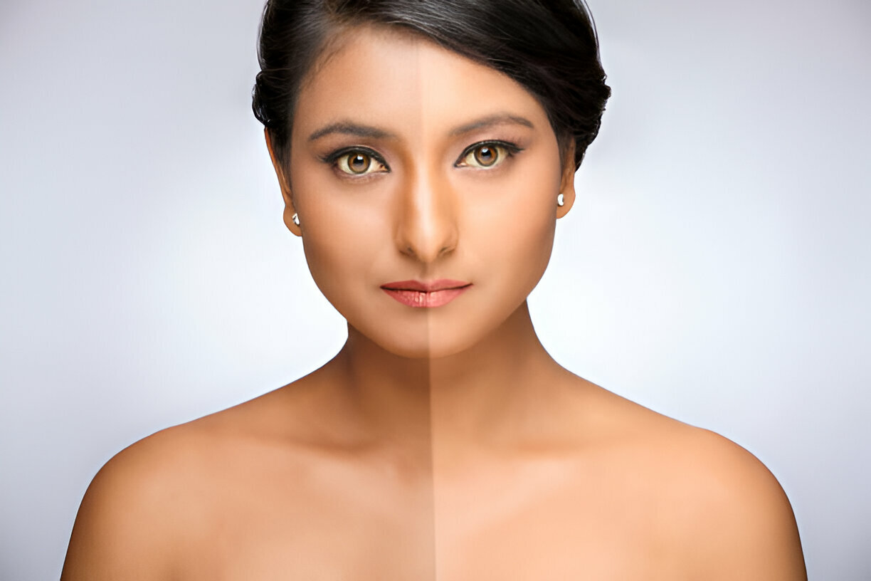 Best Skin Lightening Treatment in Hyderabad | Best Cosmetology Clinic ...